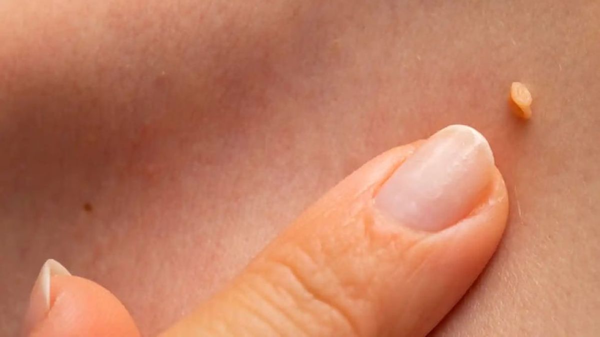 Hablemos de verrugas: qué las causa y cómo identificarlas