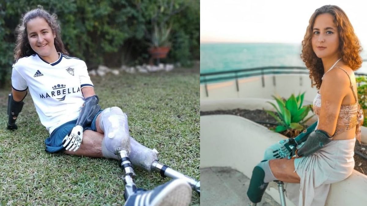 Video: perdió sus brazos y piernas por una feroz bacteria y ahora tiene ...