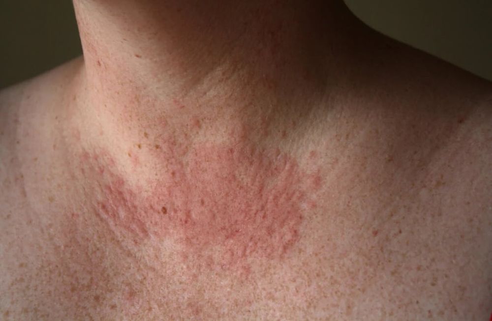 Alergias al sol: qué las provoca y cómo actuar