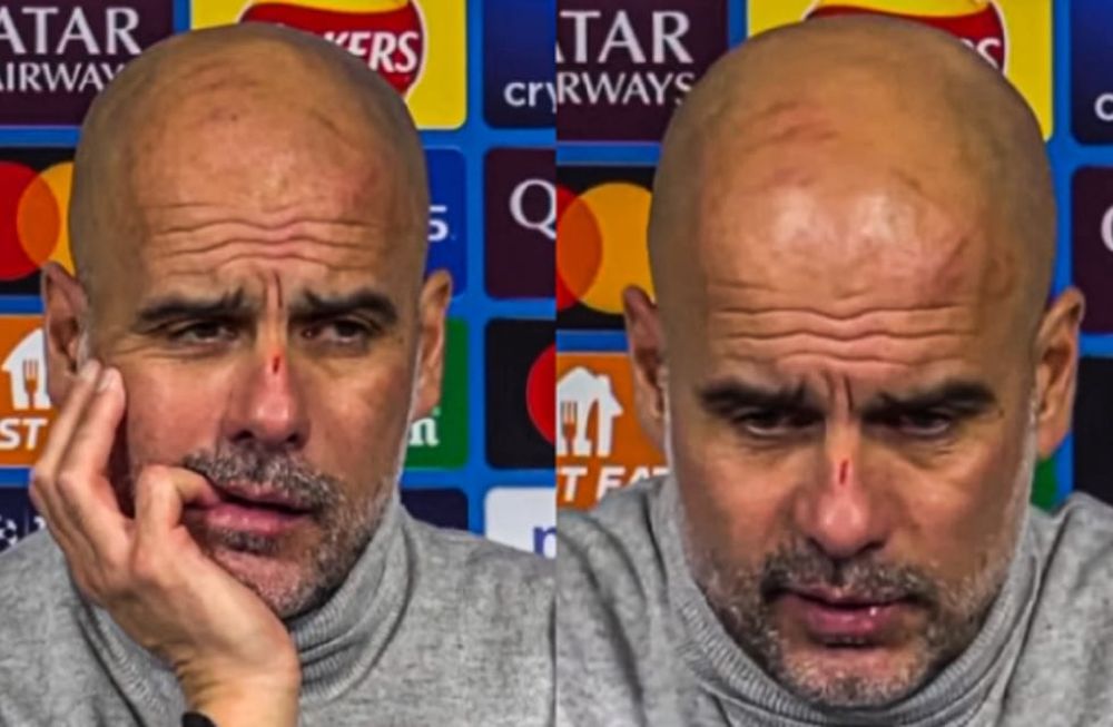 Pep Guardiola apareció con heridas en la cara y sorprendió a todos con ...