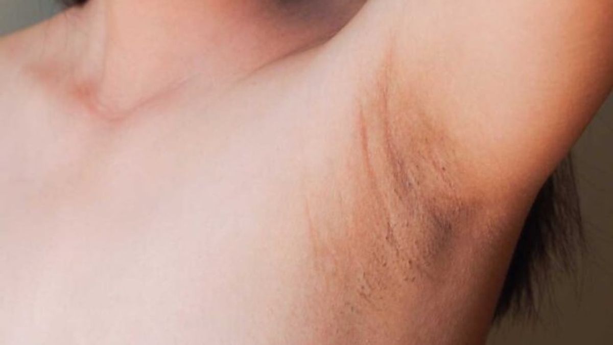 Oscurecimiento en las axilas: qué lo causa y cómo podes hacer para ...