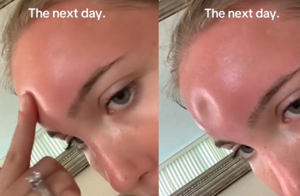 Viral: tomó sol sin protector solar durante seis horas y mostró el ...