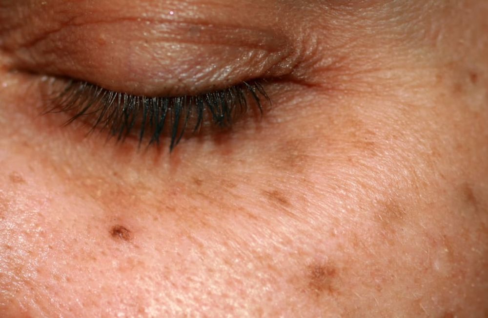 ¿Manchas de sol? Aprendé cómo prevenirlas