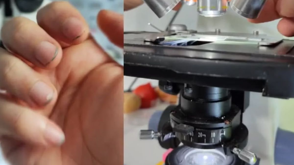 Video: se sacó la “basurita” de las uñas, analizó la muestra en un microscopio y dejó a todos en ...