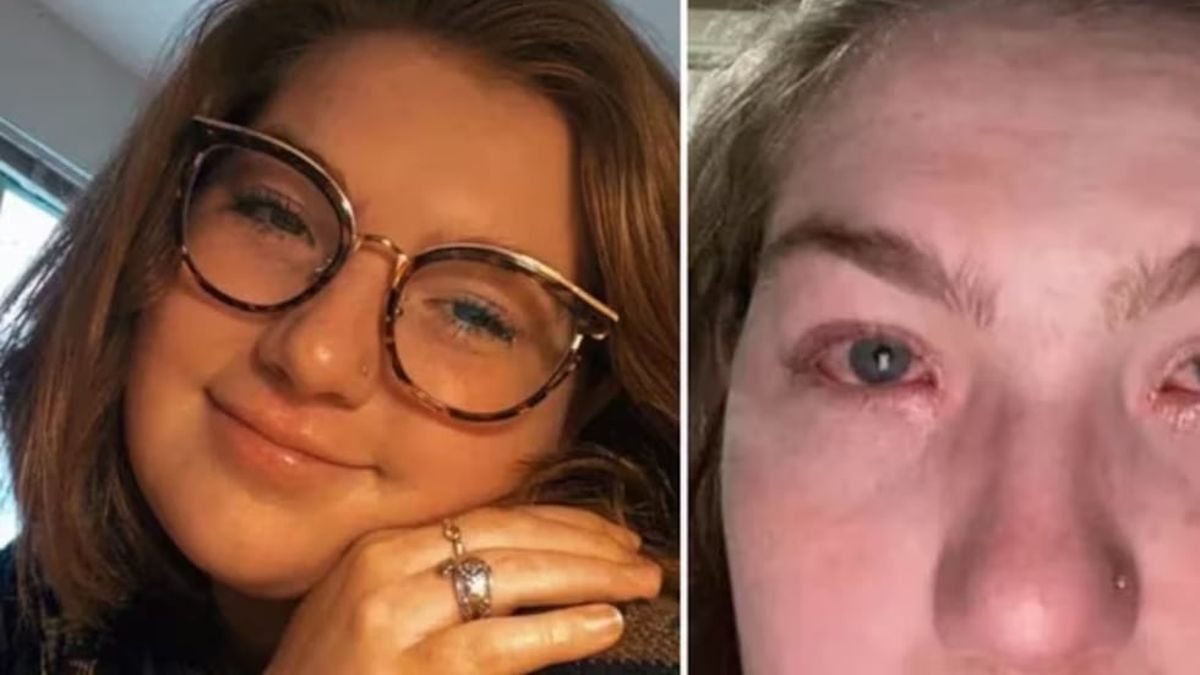 Contó que es alérgica a su novio, mostró los efectos y se hizo viral