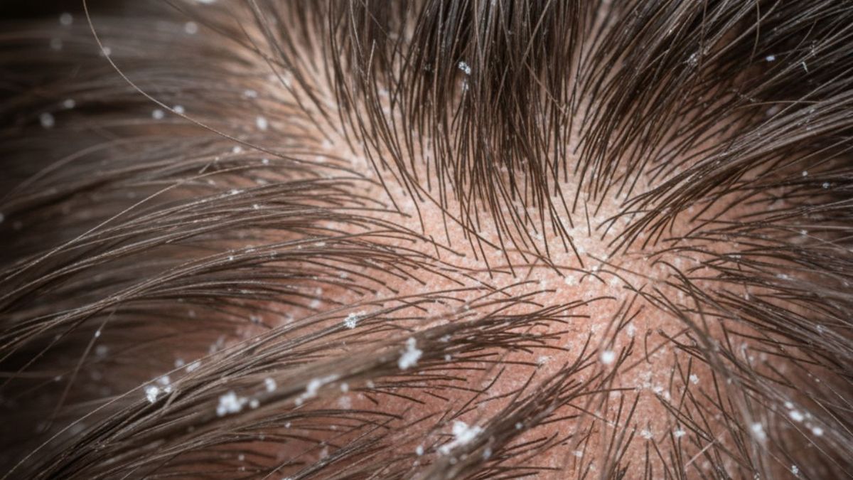 La caspa es un tema del pasado en tu cabello: cómo eliminarla para ...