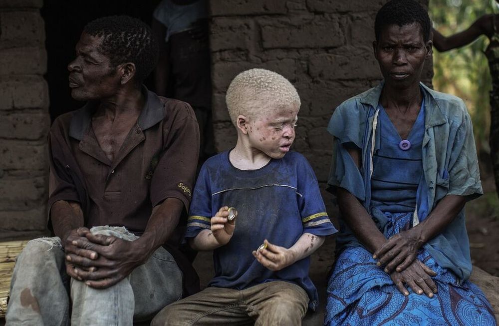 Mutilaciones, violaciones y brujerías: el drama de los albinos en África