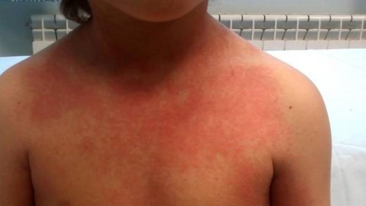 Se duplicaron los casos de escarlatina en Mendoza