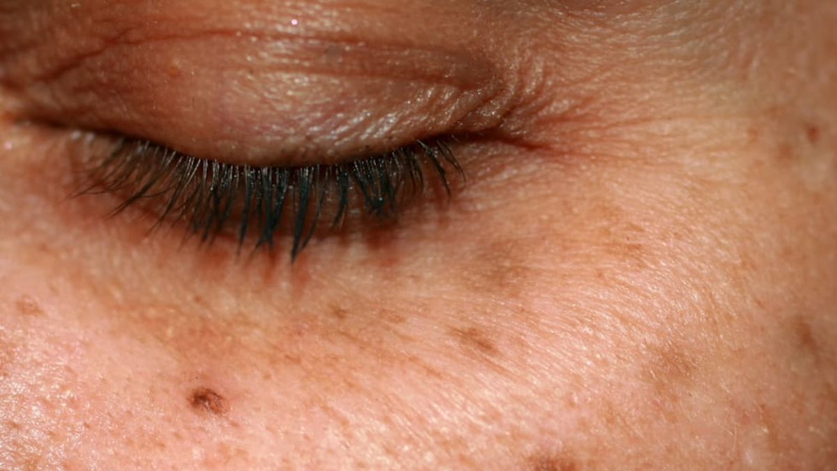 ¿Manchas de sol? Aprendé cómo prevenirlas