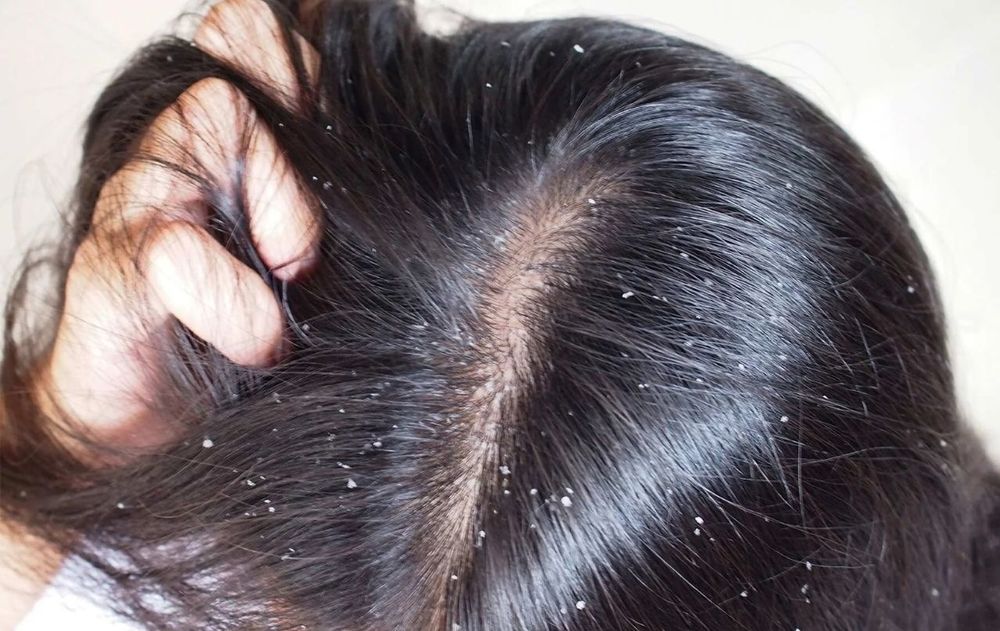 Adiós caspa: un enjuague inusual para el cabello logra eliminarla y se ...